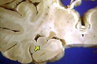 Image #22: Identify: hippocampus