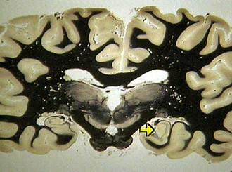 Image #23: Identify: hippocampus